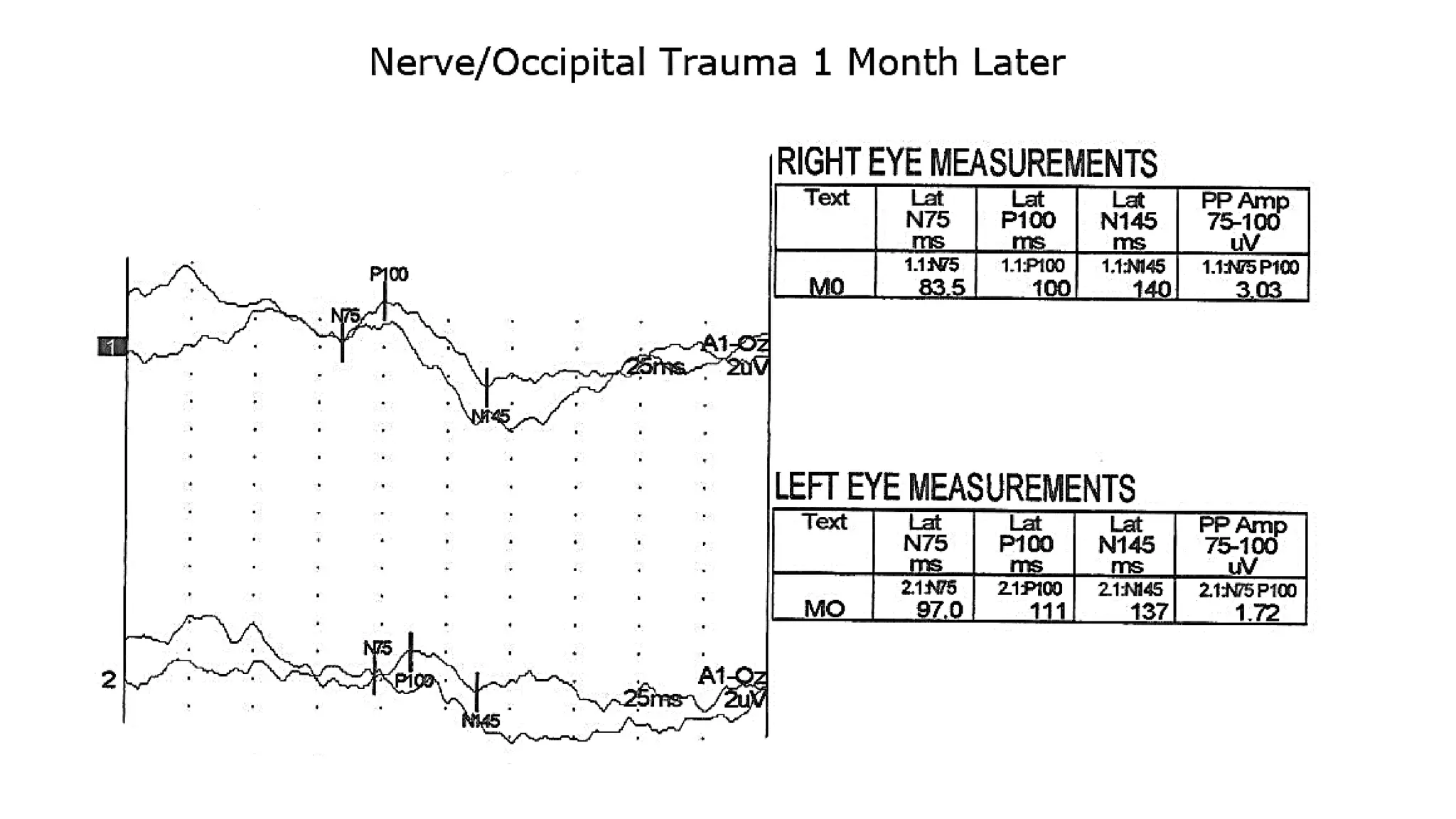 Visual Evoked Potential | PPTX