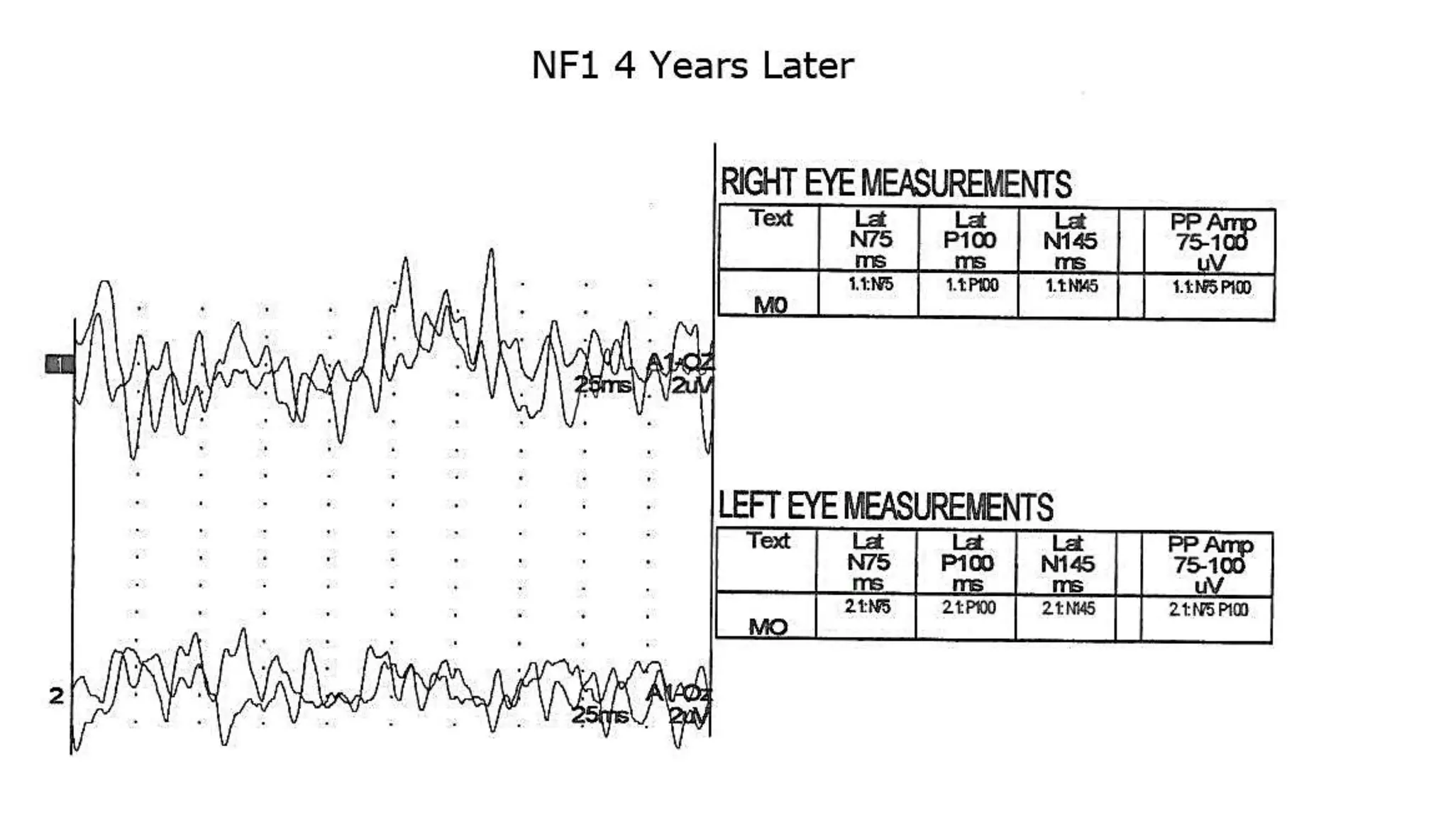 Visual Evoked Potential | PPTX
