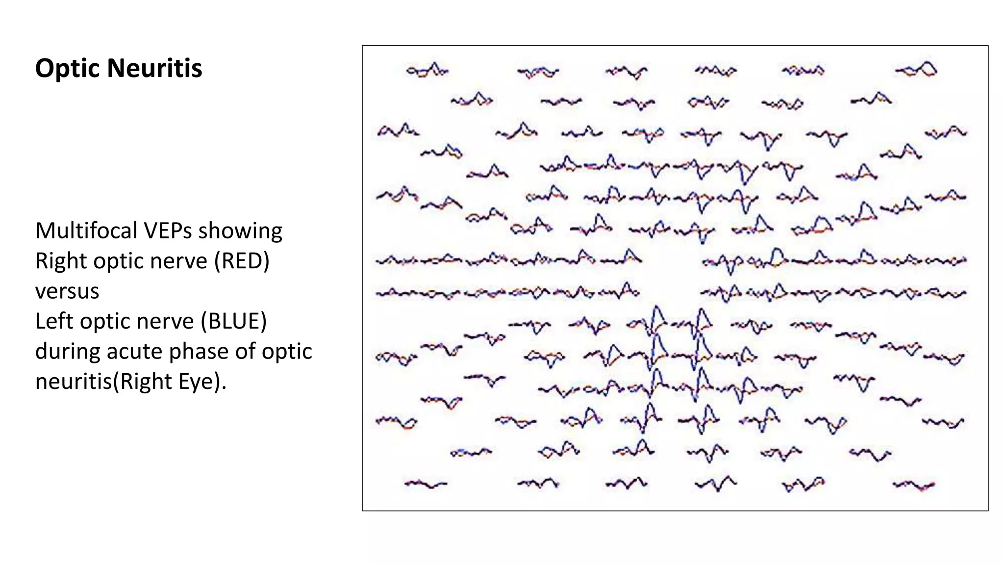Visual Evoked Potential | PPTX