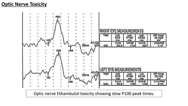 Visual Evoked Potential | PPTX