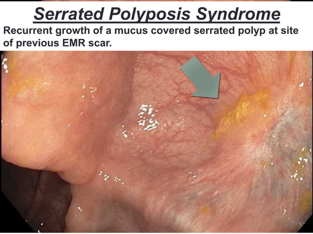 Lynch Syndrome and Serrated Polyposis Syndrome in 20 minutes. | PPTX ...