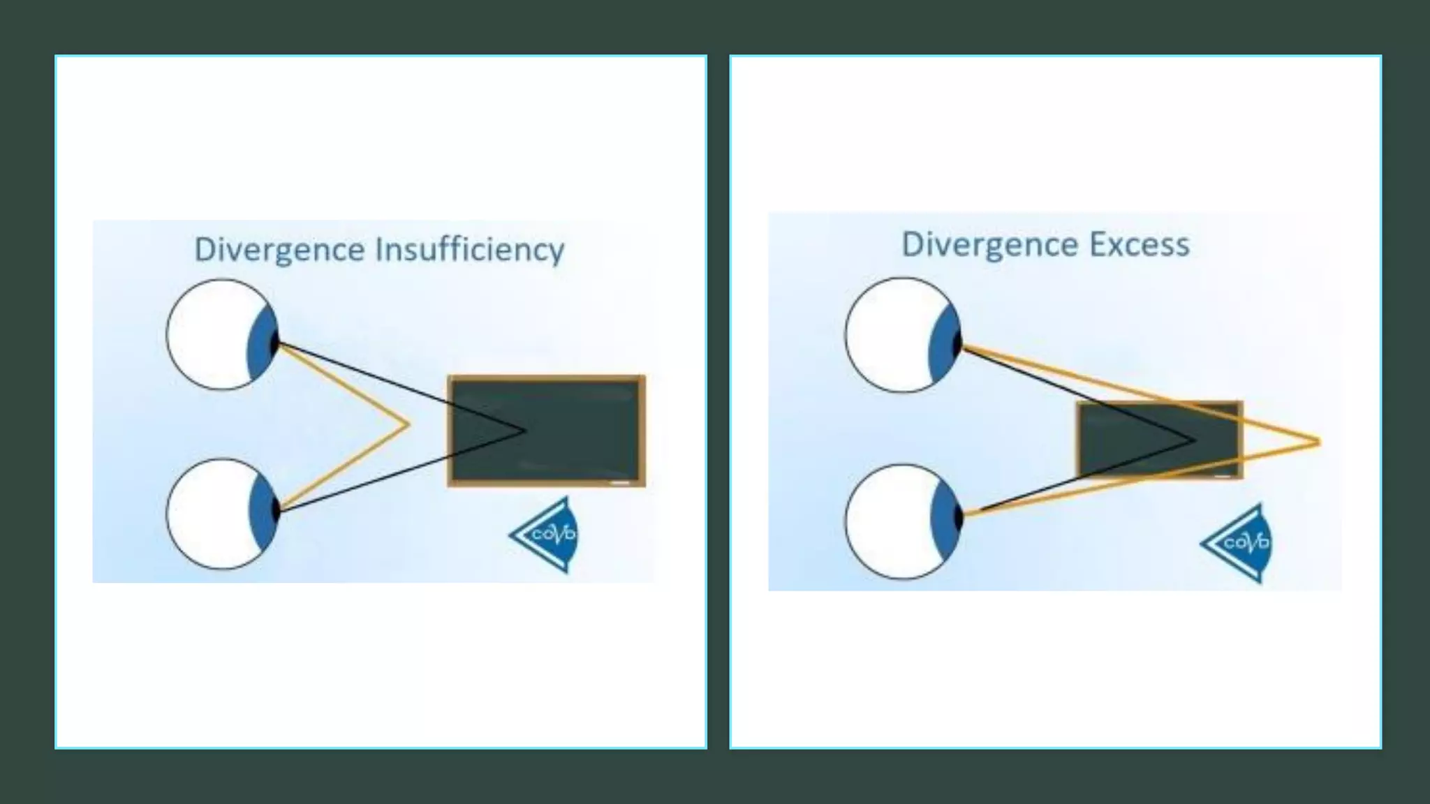 Vergence and its anomalies | PDF