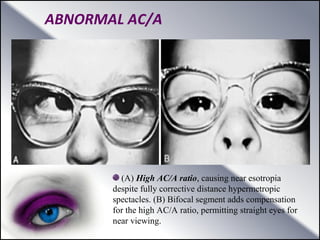 Vergences of the eye | PPT