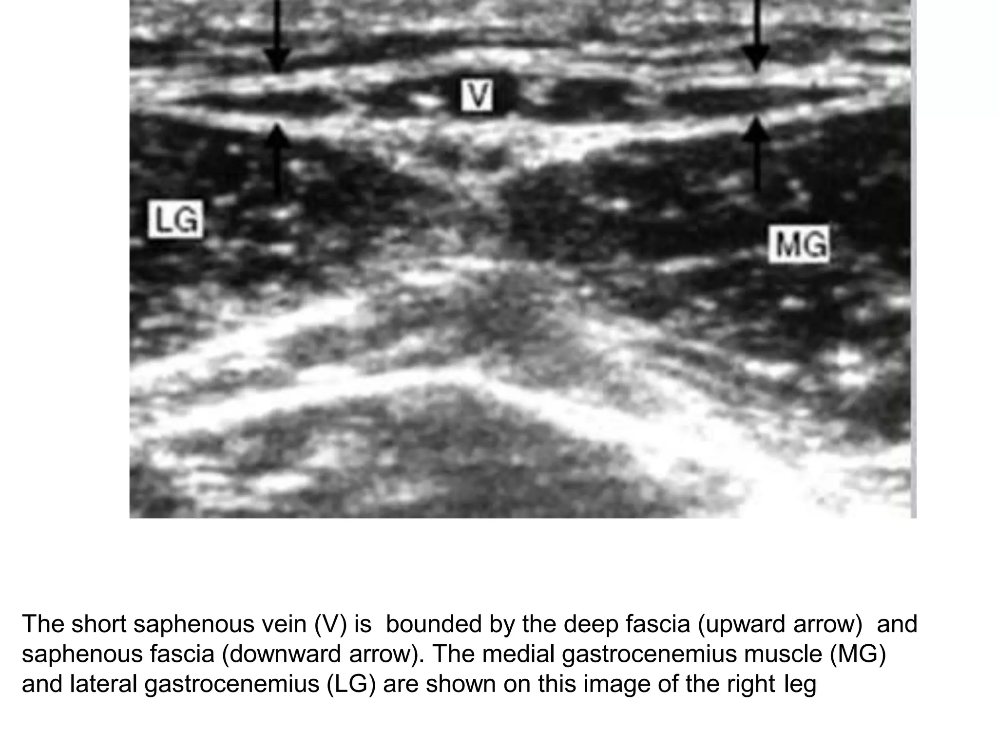 Duplex ultrasound of Vericose vein | PPTX