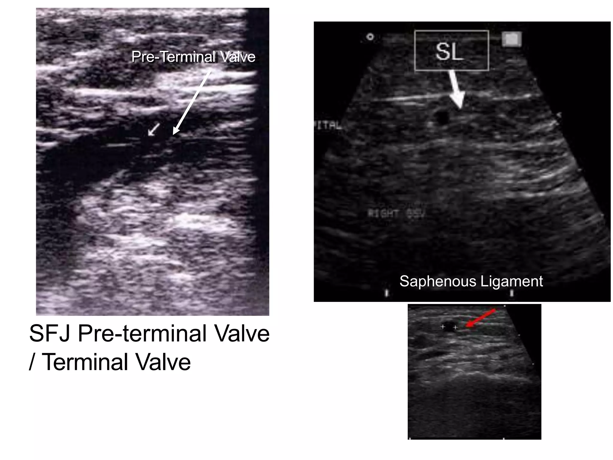 Duplex ultrasound of Vericose vein | PPTX