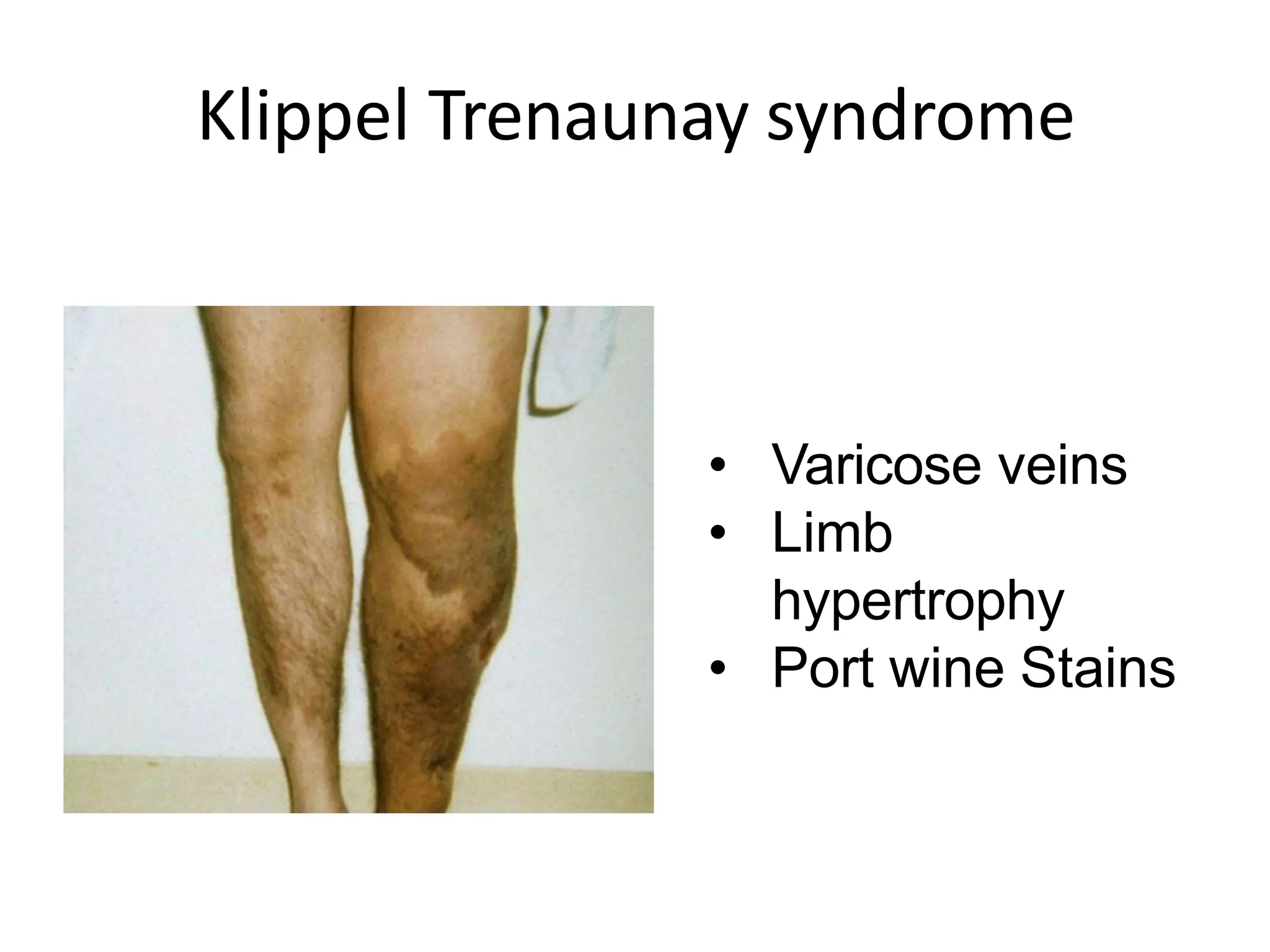 Duplex ultrasound of Vericose vein | PPTX