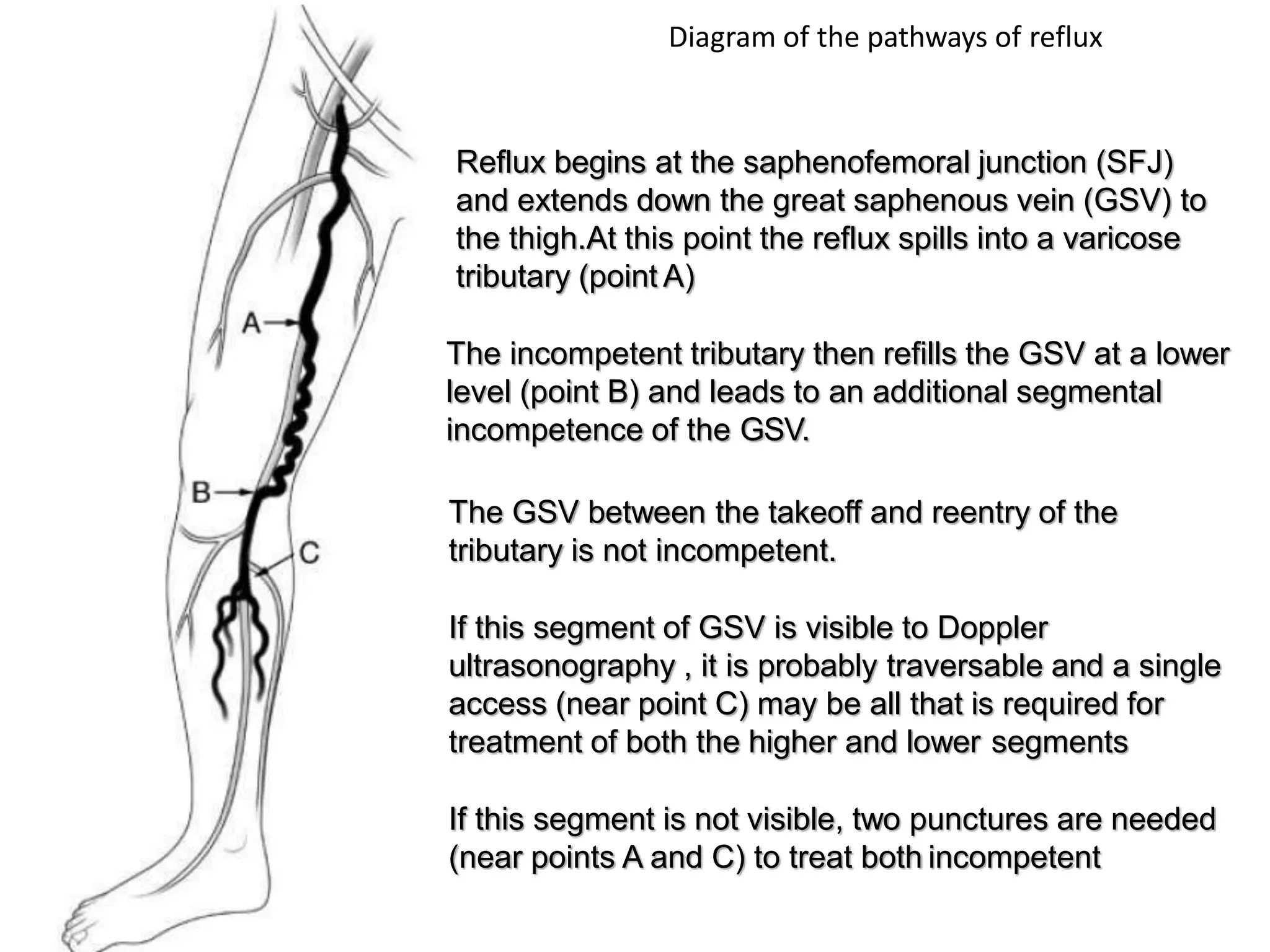 Duplex ultrasound of Vericose vein | PPTX