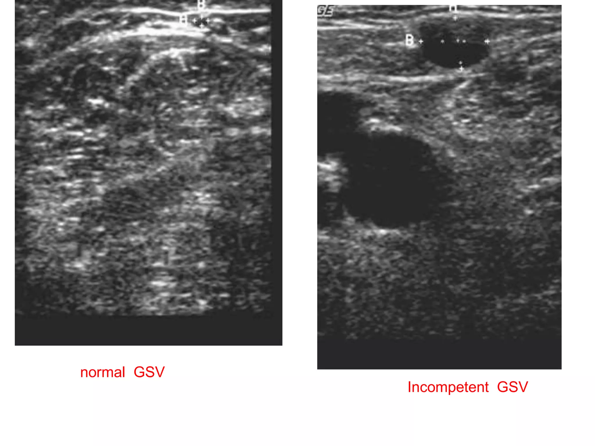 Duplex ultrasound of Vericose vein | PPTX