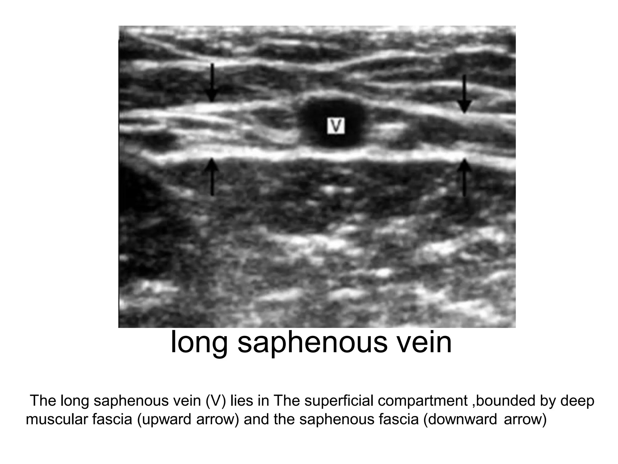 Duplex ultrasound of Vericose vein | PPTX
