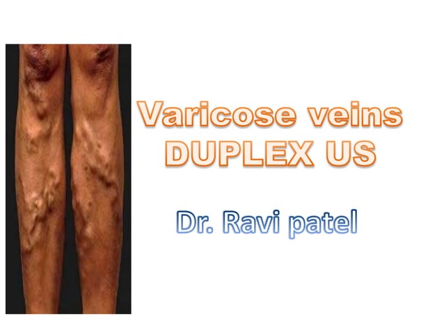 Duplex ultrasound of Vericose vein | PPTX | Heart and Cardiovascular ...