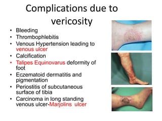 Duplex ultrasound of Vericose vein | PPTX