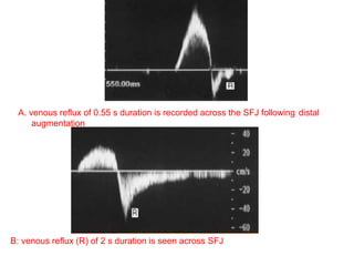 Duplex ultrasound of Vericose vein | PPTX