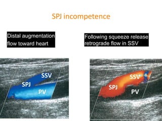 Duplex ultrasound of Vericose vein | PPTX