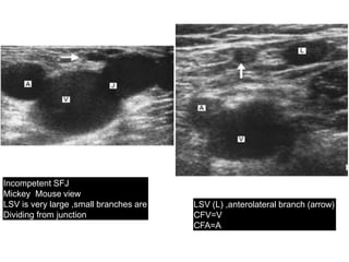 Duplex ultrasound of Vericose vein | PPTX