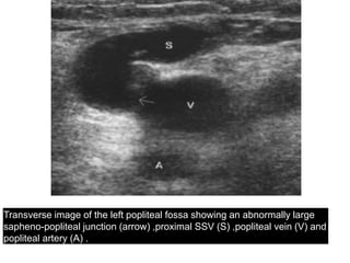 Duplex ultrasound of Vericose vein | PPTX