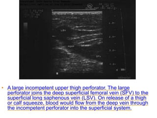 Duplex ultrasound of Vericose vein | PPTX