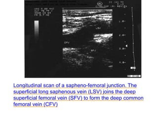 Duplex ultrasound of Vericose vein | PPTX