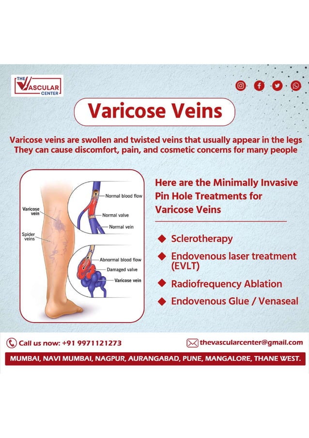 Varicose Veins- The Vascular Center | PDF