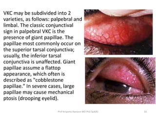 Vernal conjunctivitis | PPT