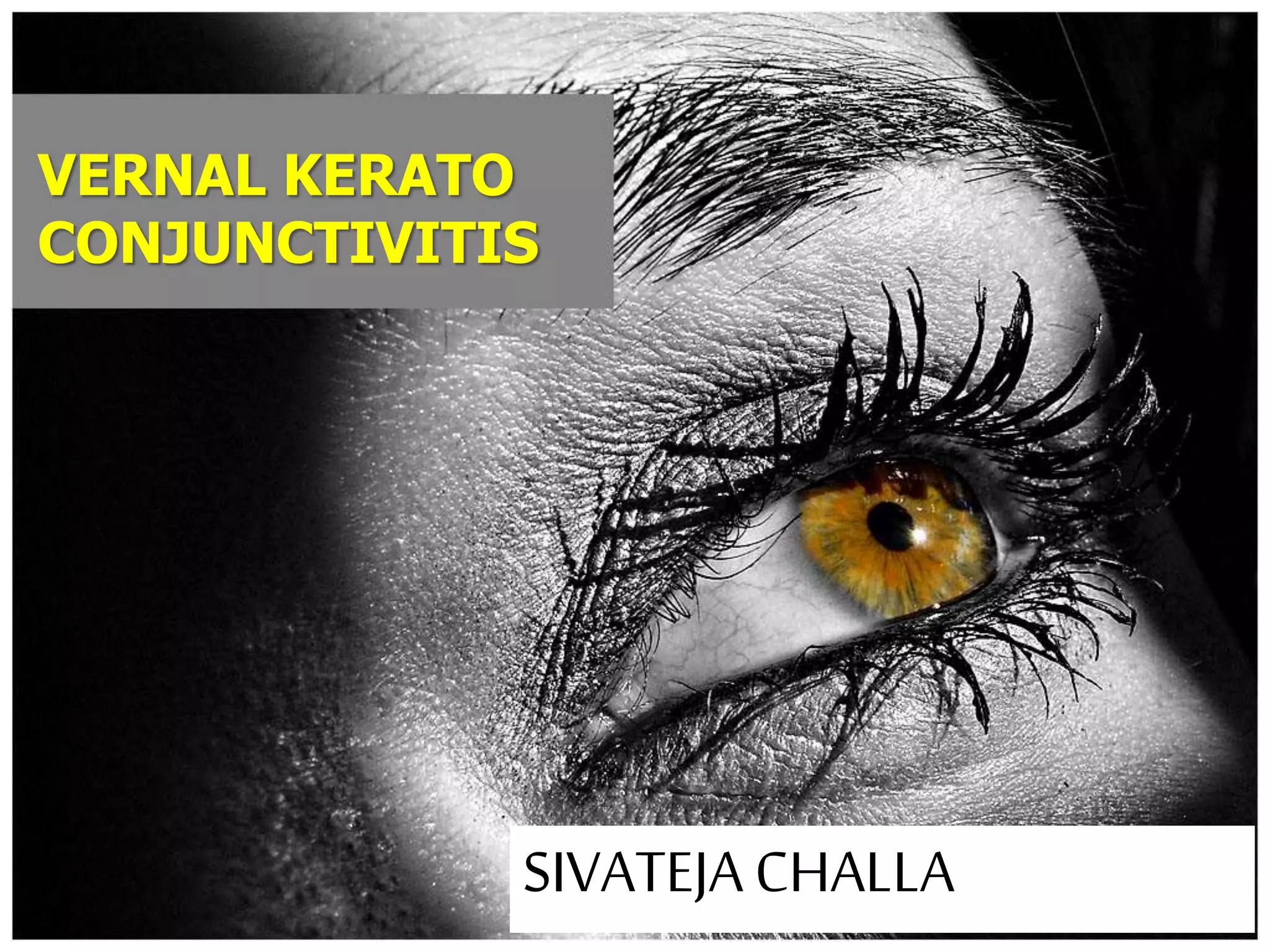 Vernal kerato conjunctivitis | PPT