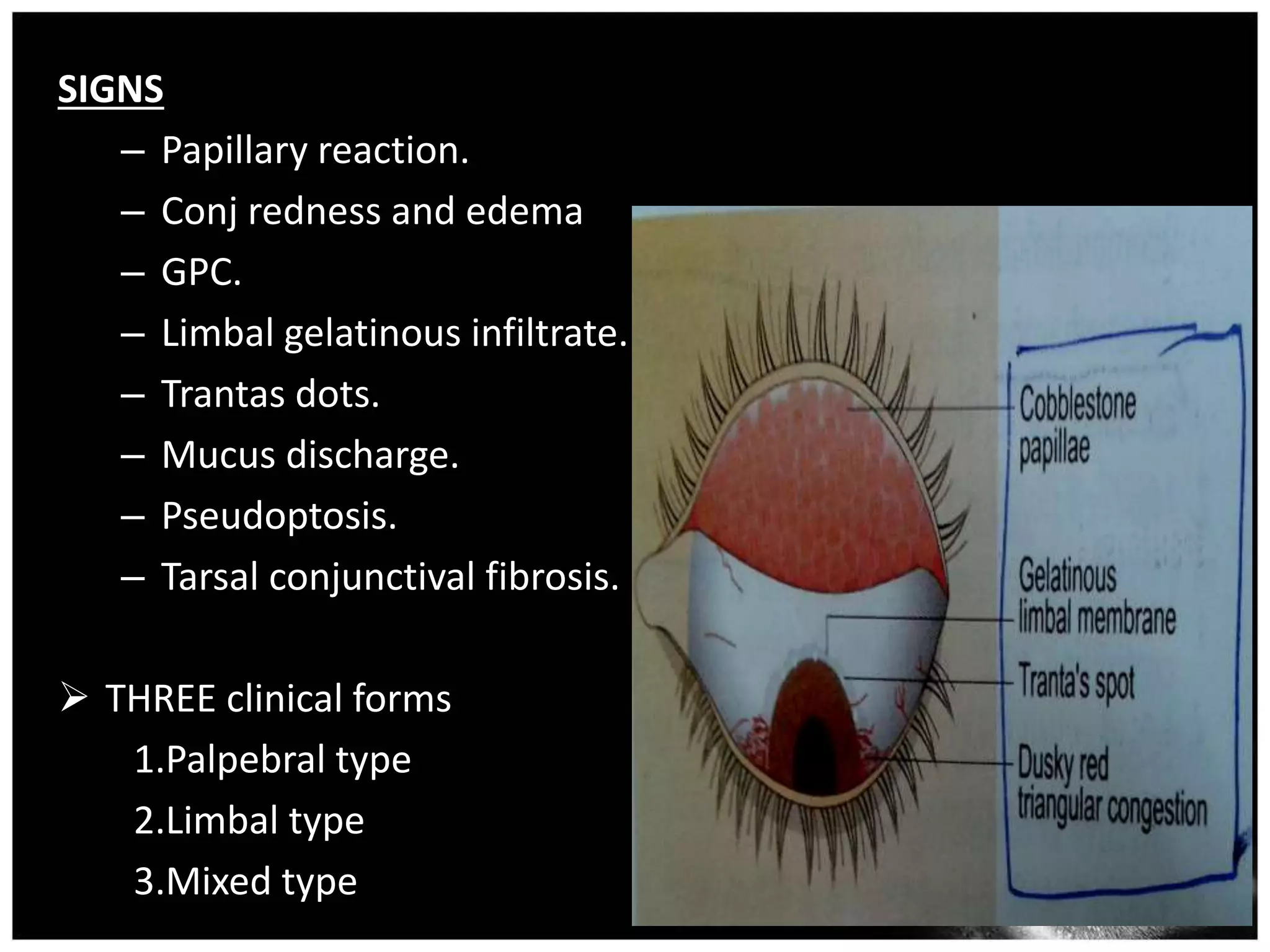 Vernal kerato conjunctivitis | PPT