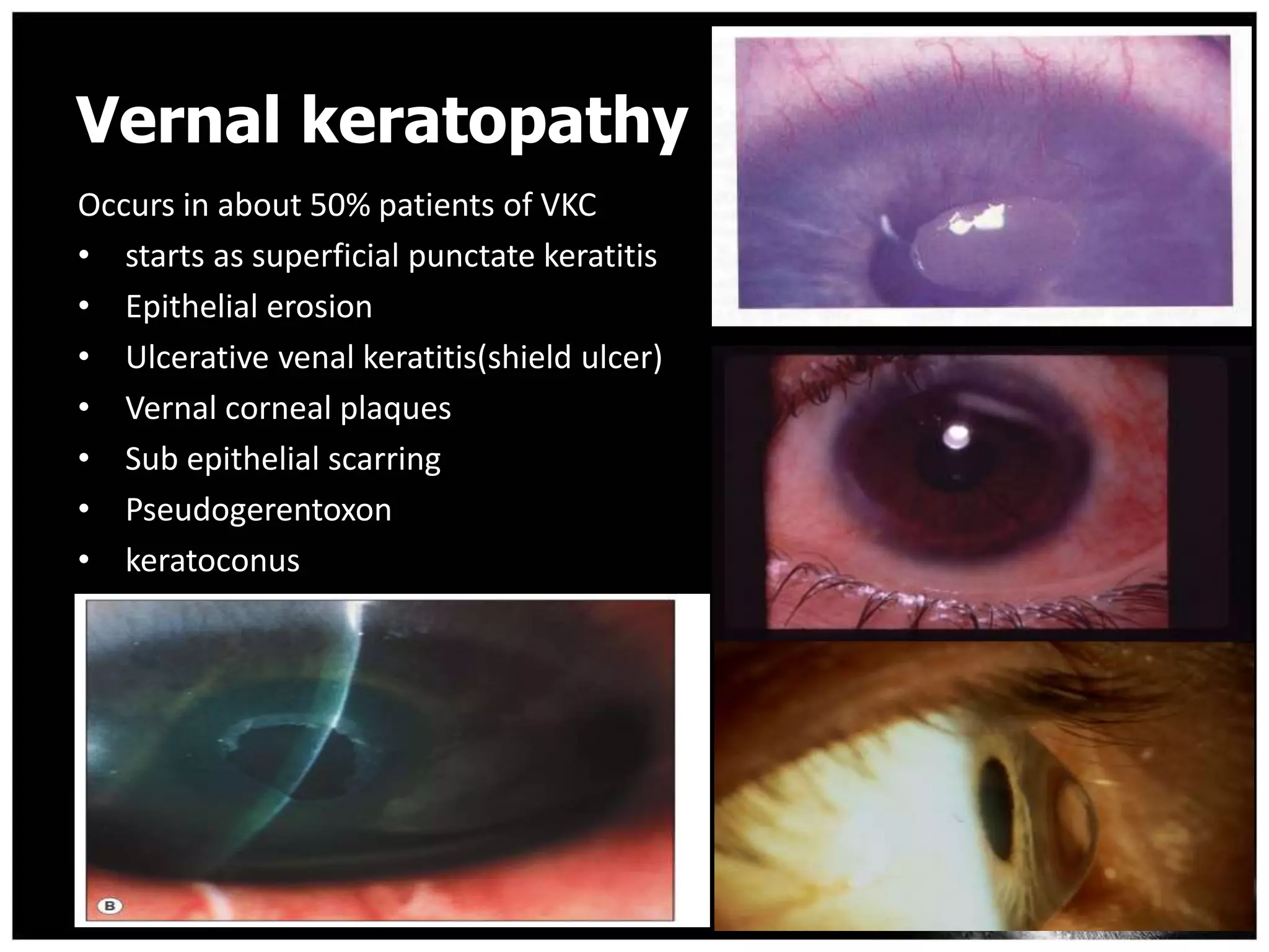 Vernal kerato conjunctivitis | PPTX