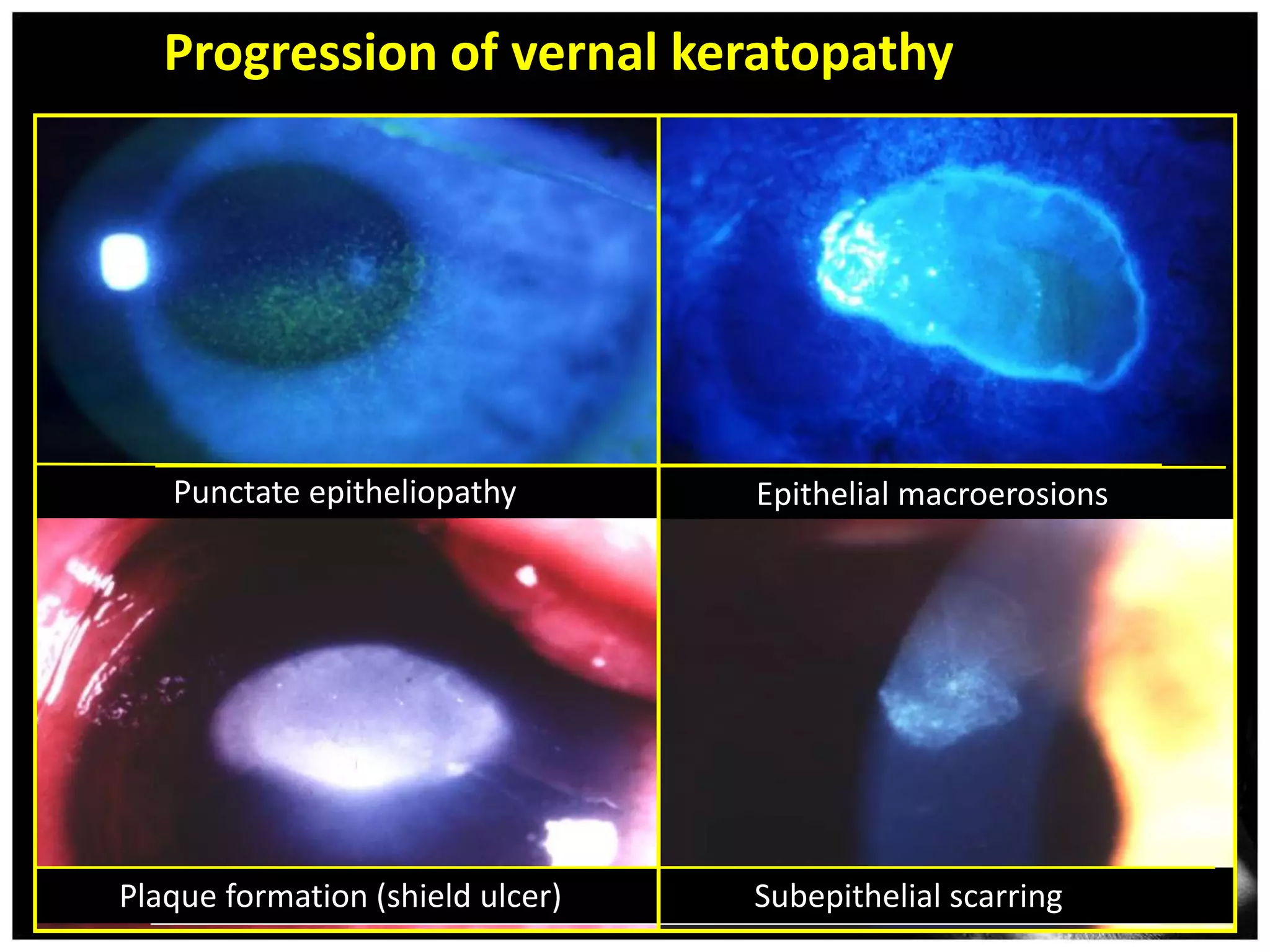 Vernal kerato conjunctivitis | PPTX