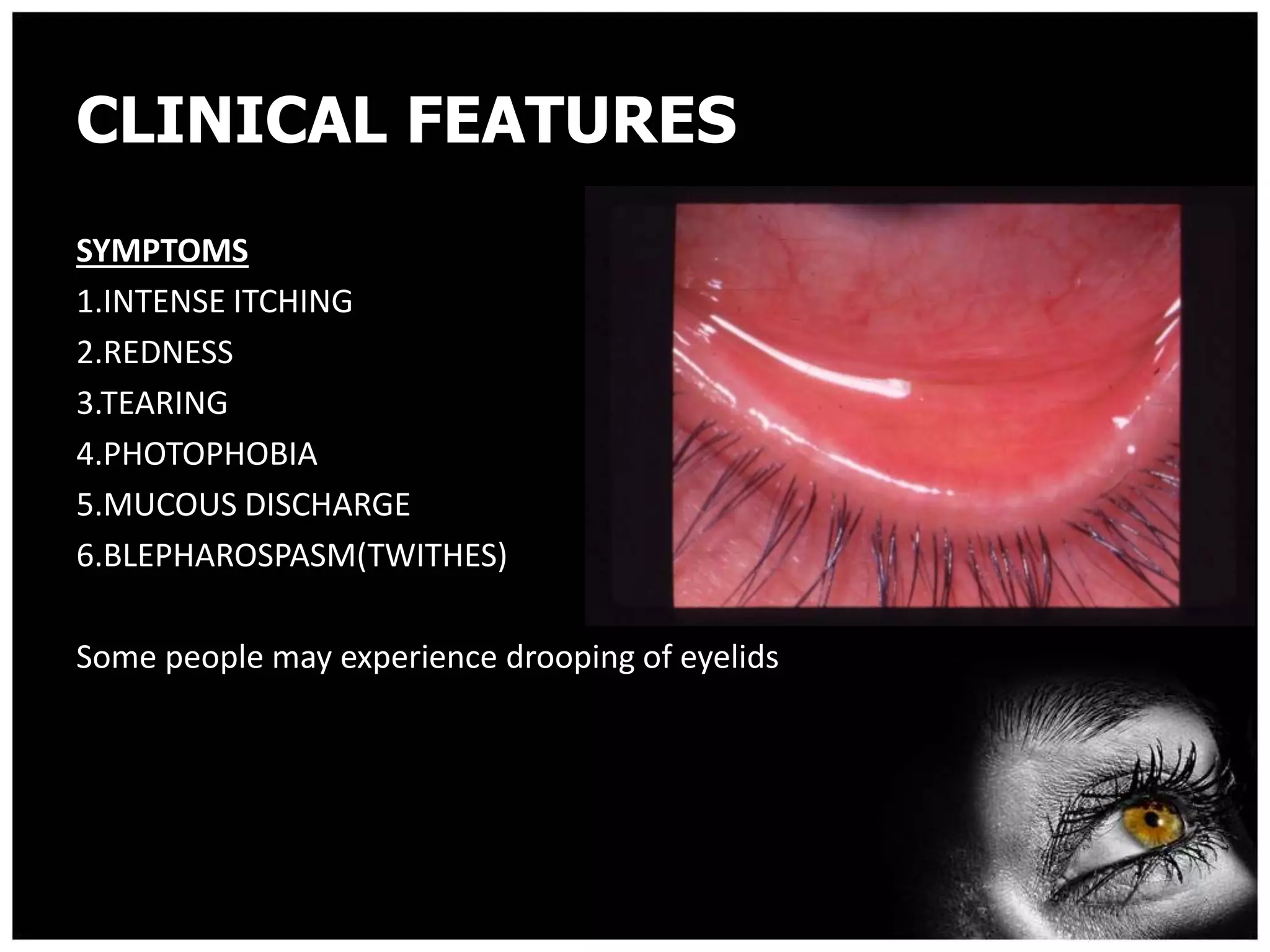 Vernal kerato conjunctivitis | PPTX
