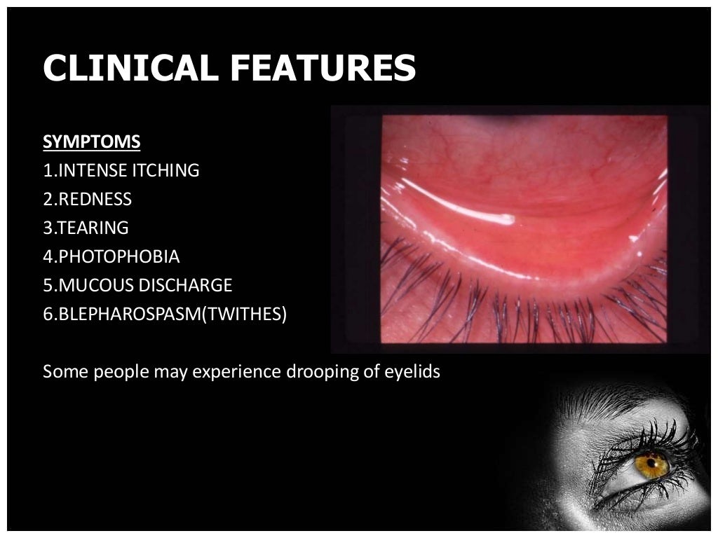 Vernal kerato conjunctivitis
