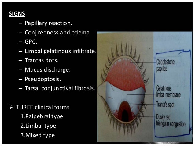 Vernal kerato conjunctivitis