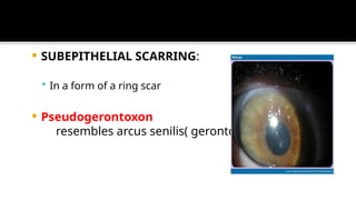 vernalkerato....conjunctivitis-140909185523-phpapp02.pptx