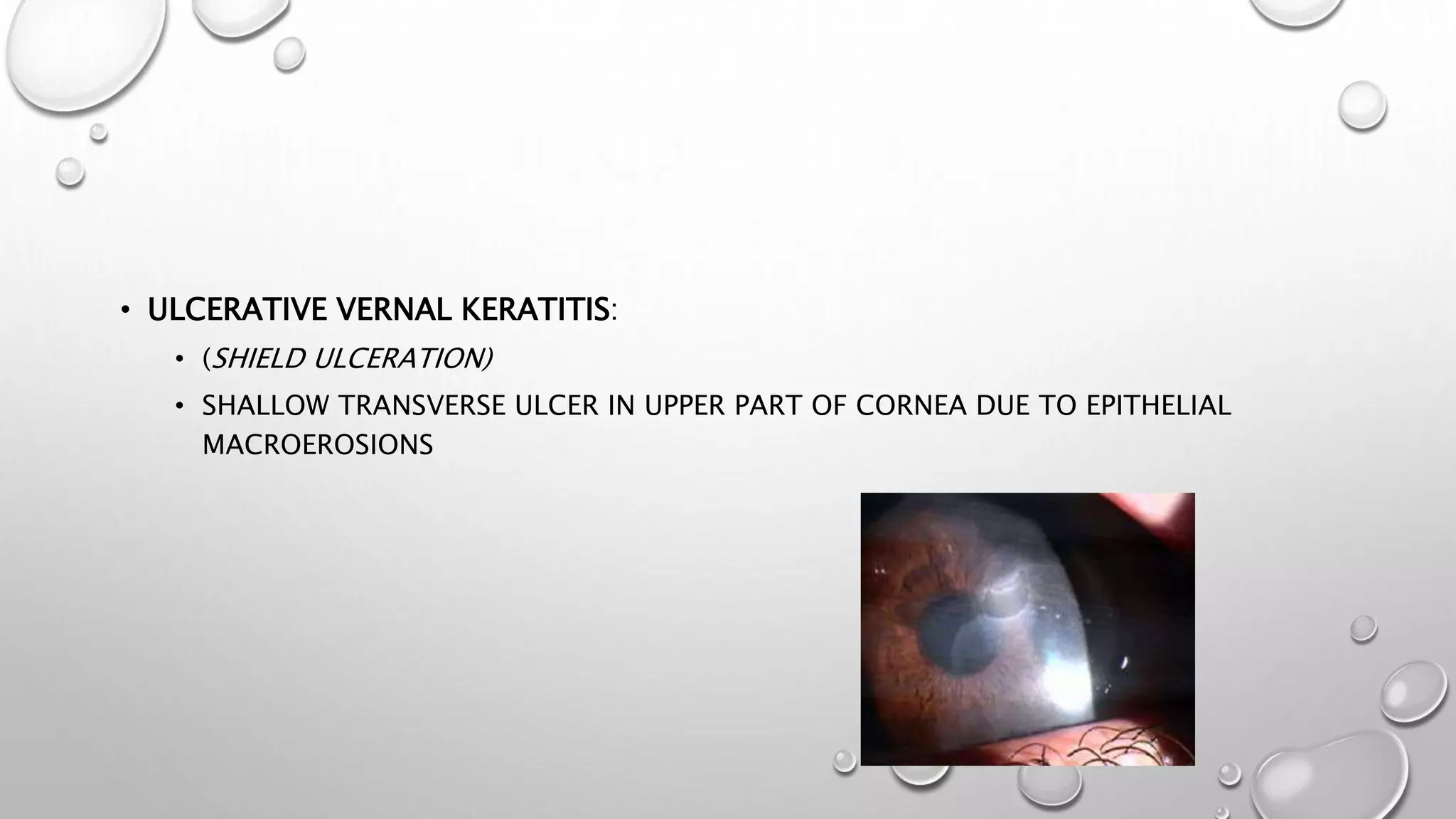 Vernal keratoconjunctivitis ophthalmology | PPTX