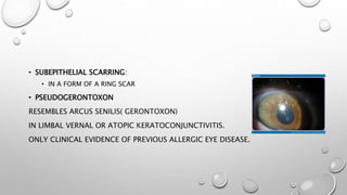 Vernal keratoconjunctivitis ophthalmology | PPTX