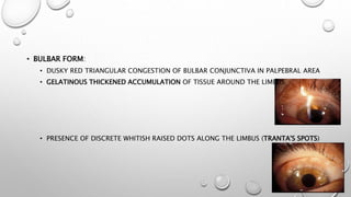 Vernal keratoconjunctivitis ophthalmology | PPTX