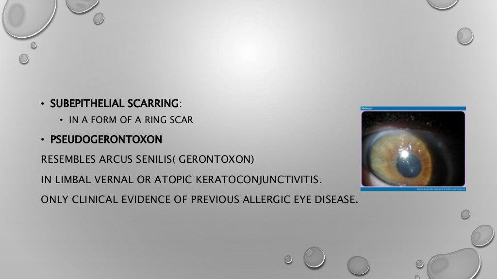 Vernal keratoconjunctivitis ophthalmology