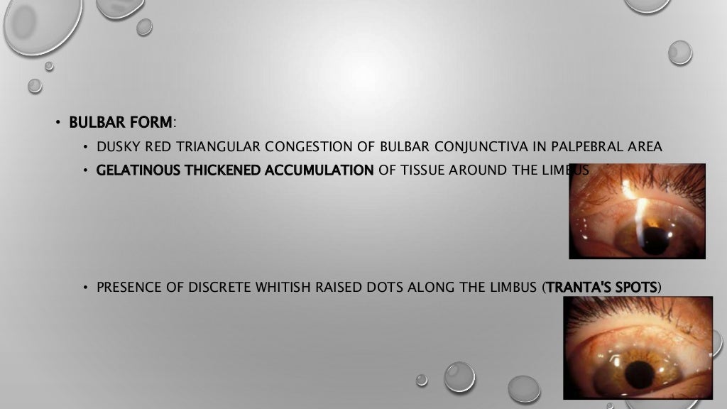 Vernal keratoconjunctivitis ophthalmology