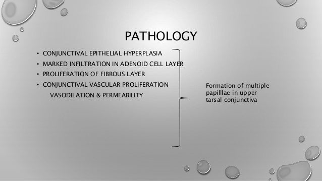 Vernal keratoconjunctivitis ophthalmology