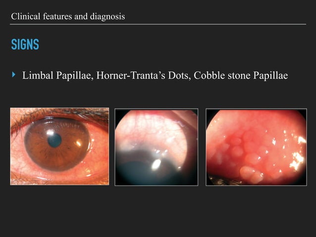 Vernal keratoconjunctivitis