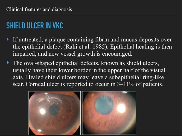 Vernal keratoconjunctivitis
