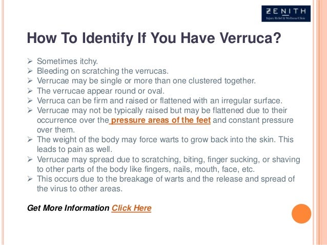 Verruca - Symptoms, Treatments, Illnesses & Conditions