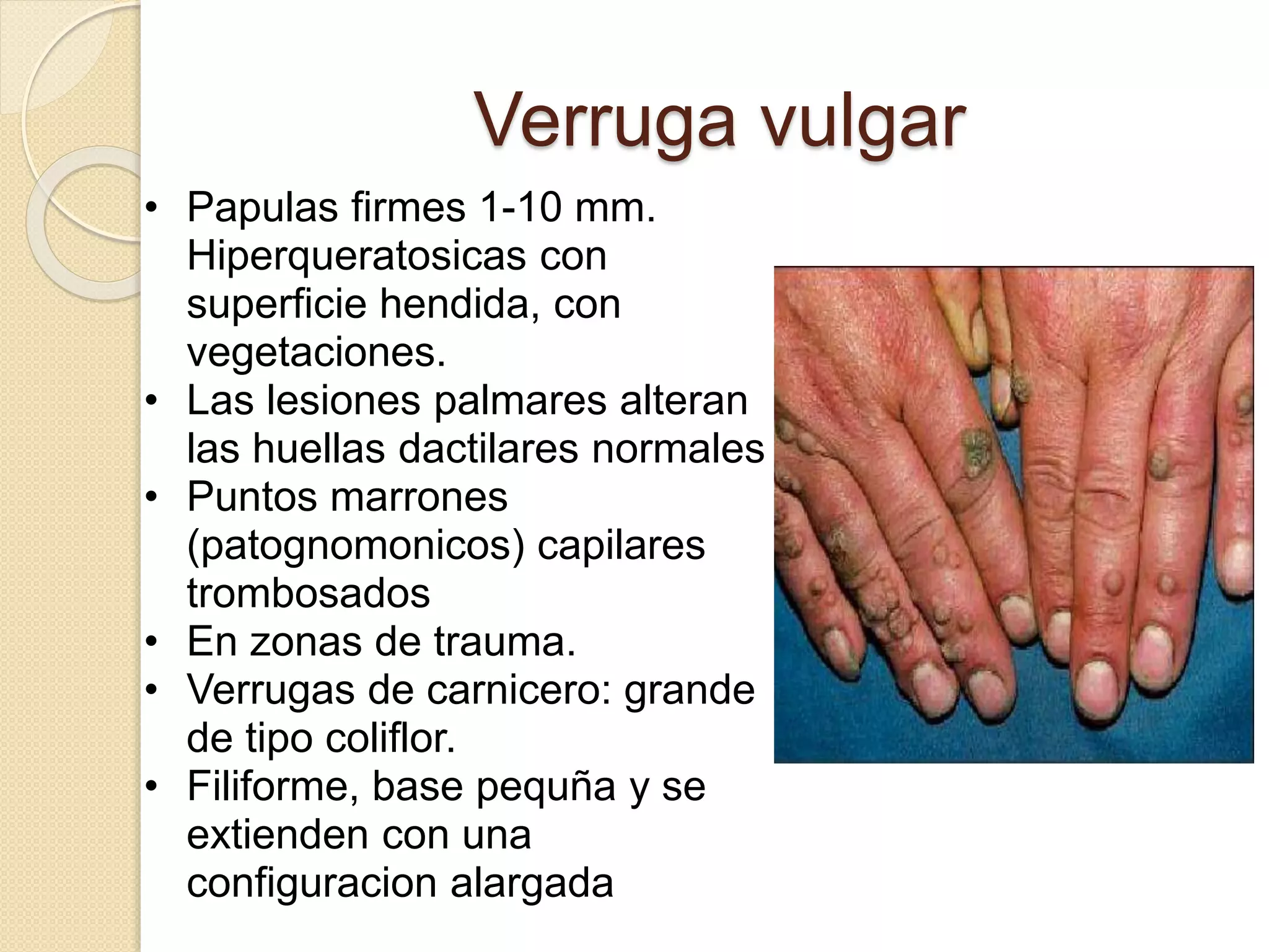 Verrugas