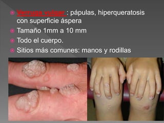 Verrugas | PPTX