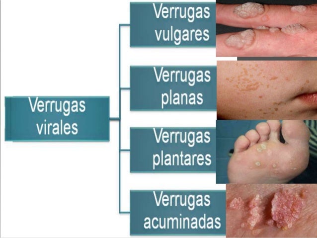 Verrugas
