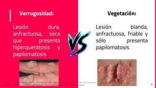 Dermatosis viral, verrugas, vph | PPTX