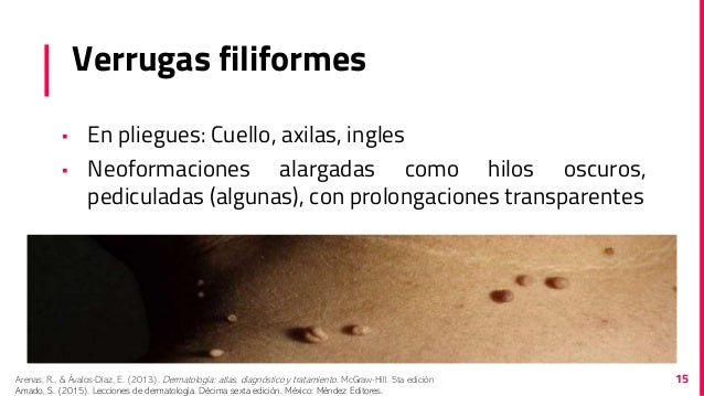 Dermatosis viral, verrugas, vph