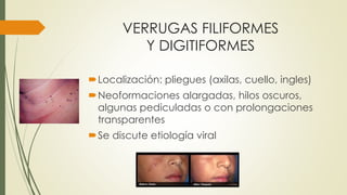 Verrugas virales | PPTX