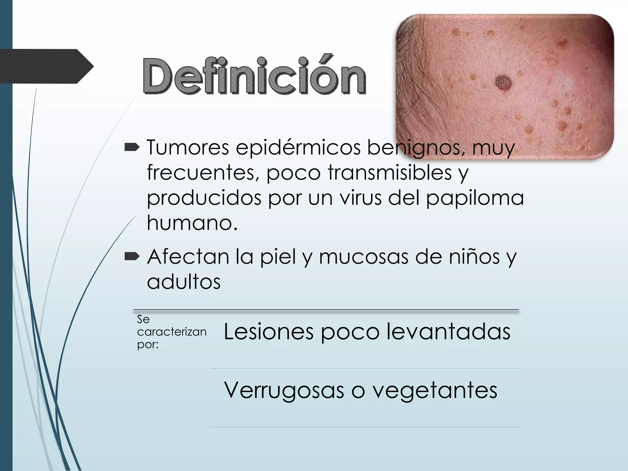 Verrugas virales | PPT