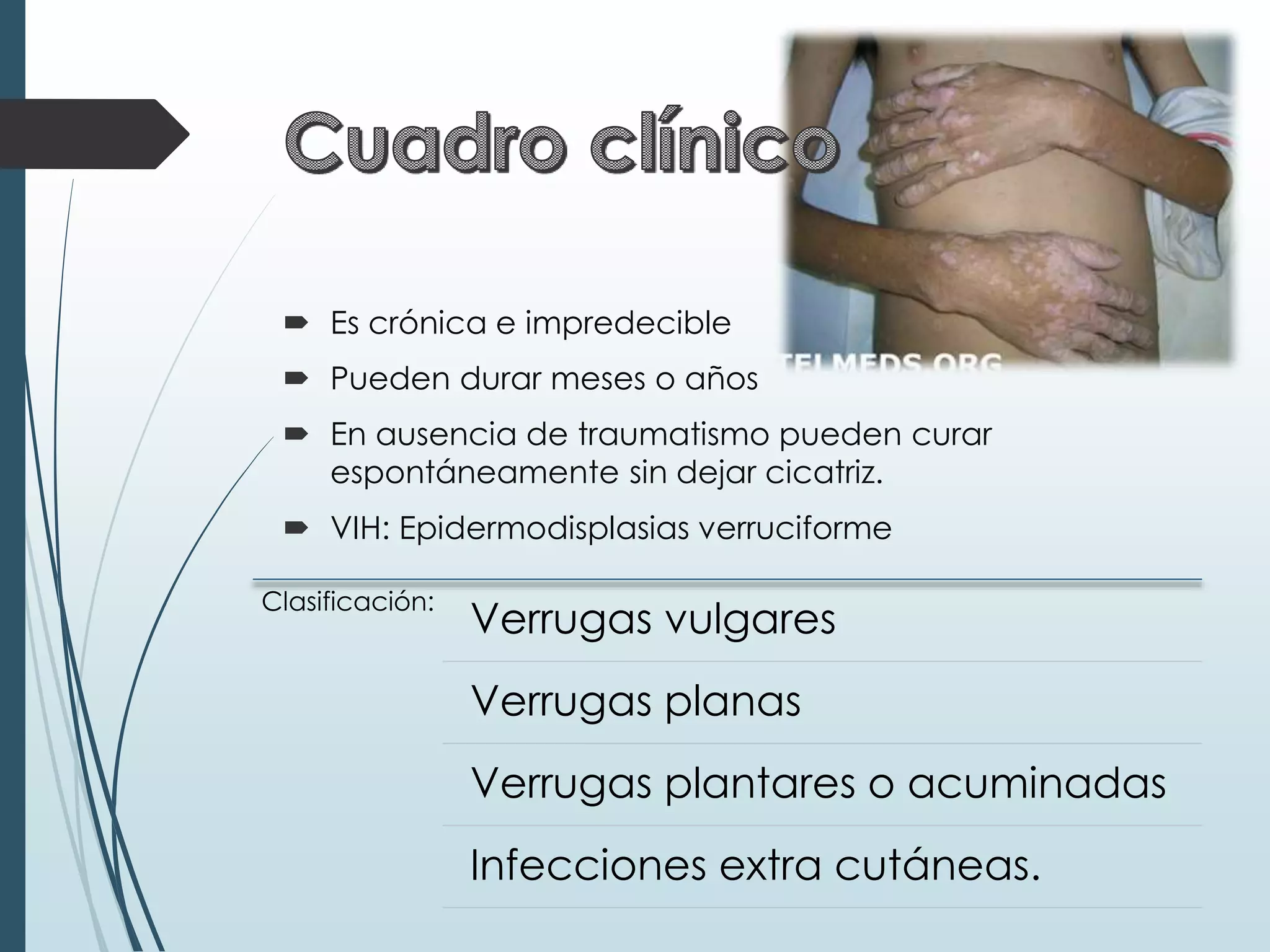 Verrugas virales | PPT