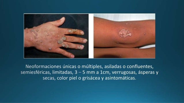 Verrugas virales y condiloma acuminado