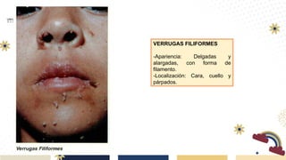 verrugas viricas dermatolgia caso clinico | PPTX